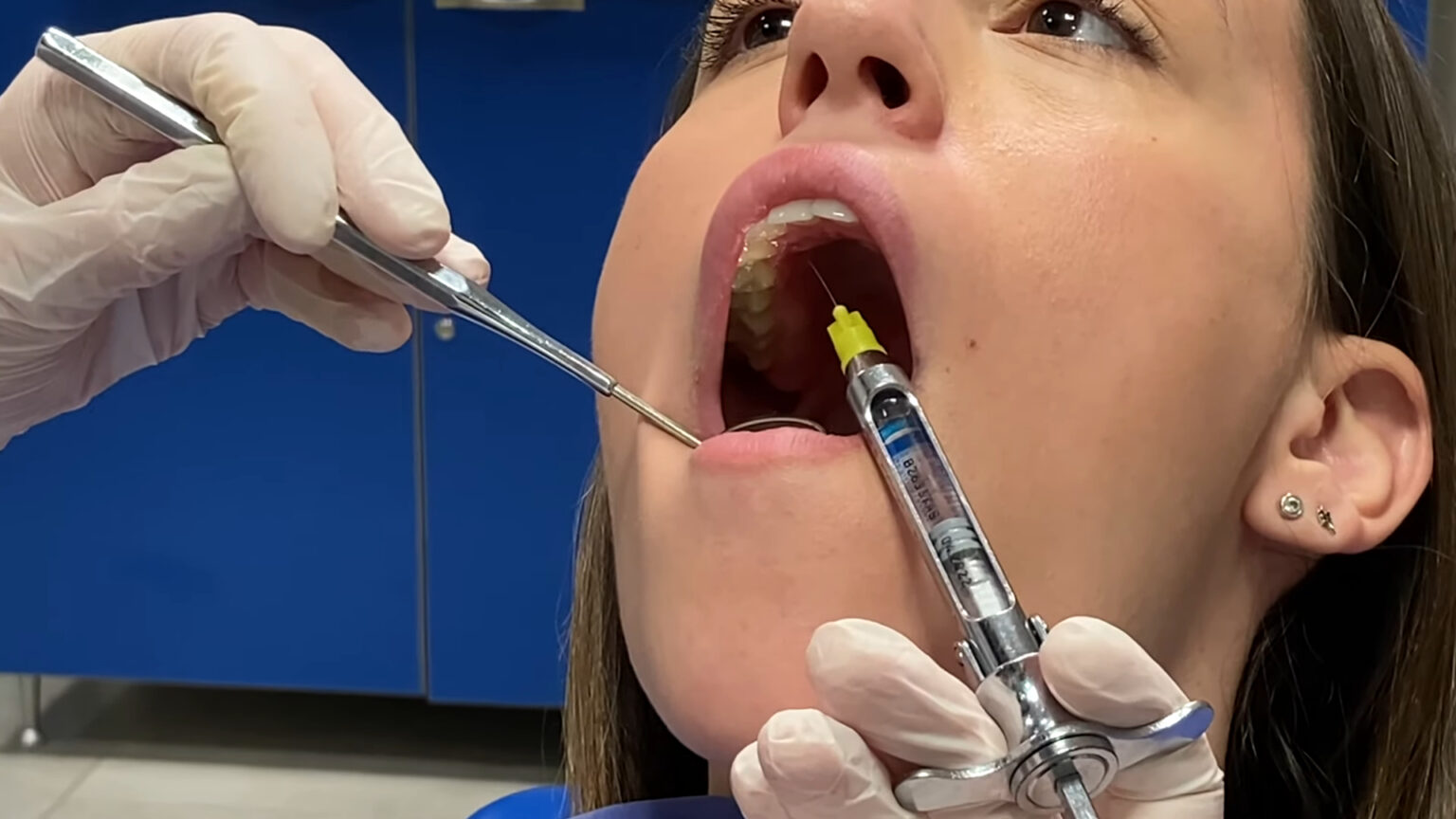 Koliko traje anestezija zuba? Koji faktori utiču na dužinu trajanja ...